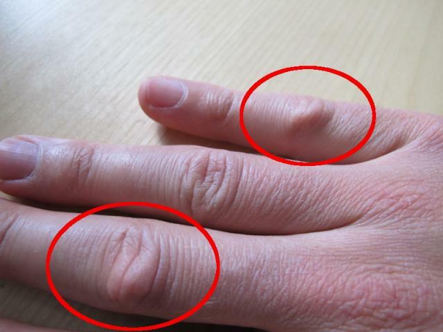 Behandling af hårde knopper på fingerled | HelePlanter.dk